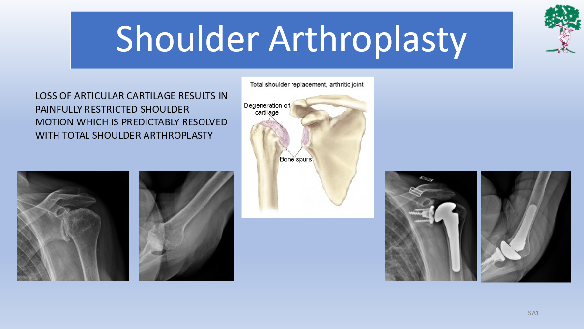 Shoulder Care - Dr. Steven T. Plomaritis, DO